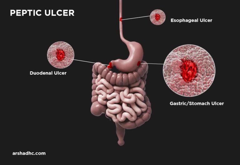 An Ulcer Story - Simply Sentient